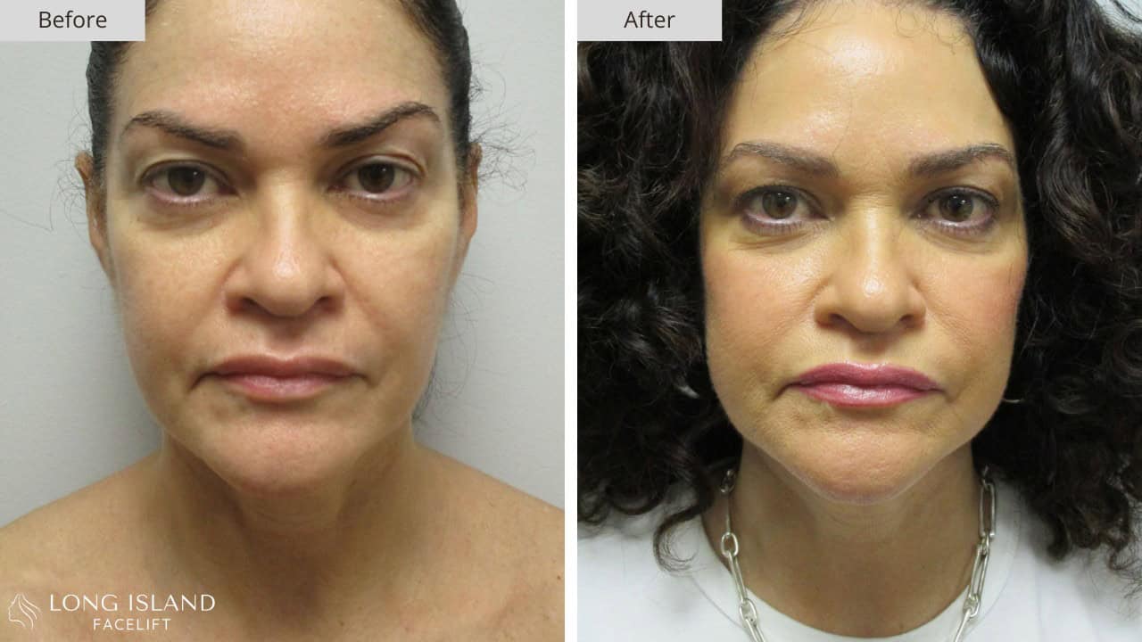 Long Island Facelift Surgery: Before & After Results
