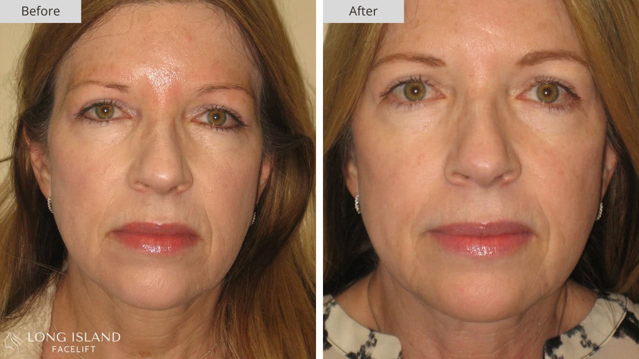 Long Island Facelift Surgery: Before & After Results