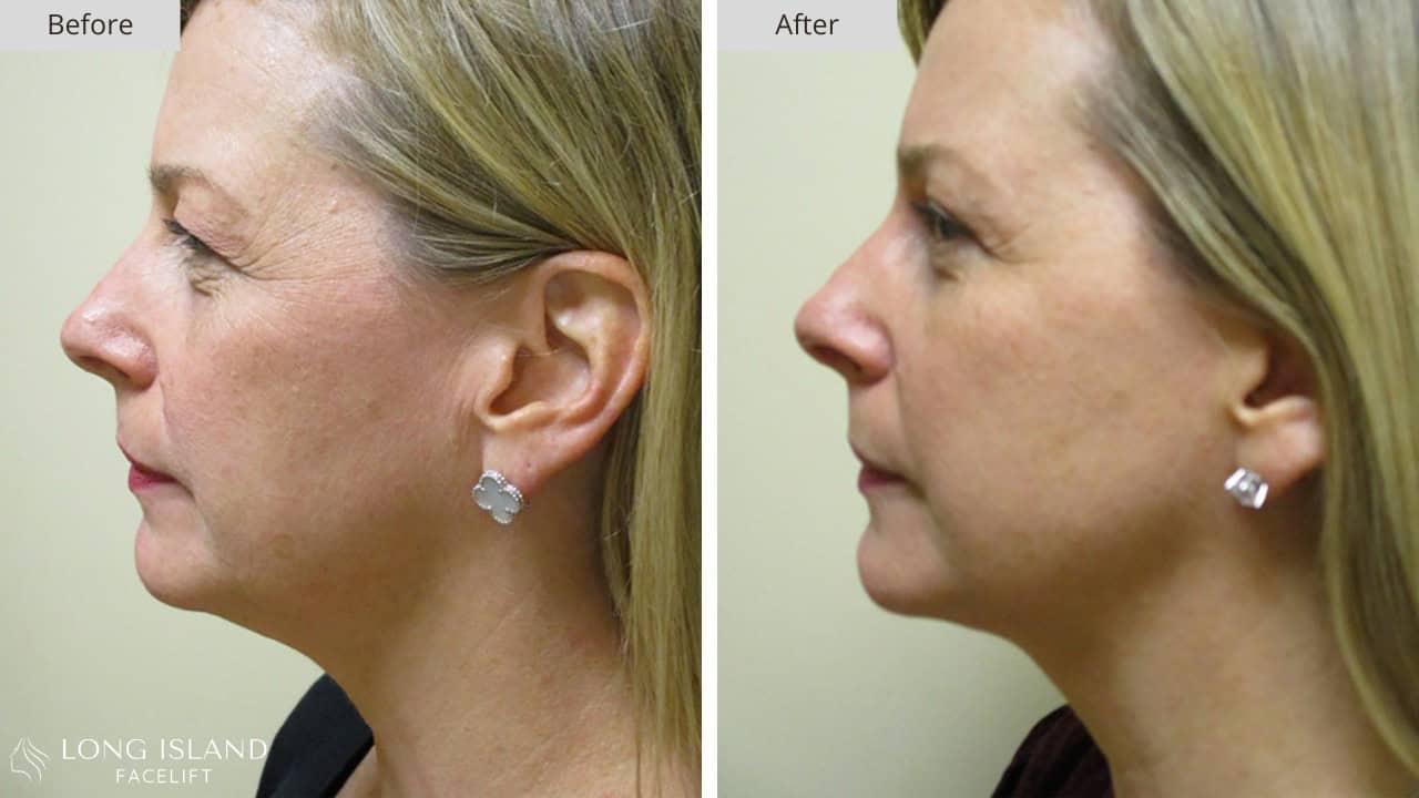 Long Island Facelift Surgery: Before & After Results